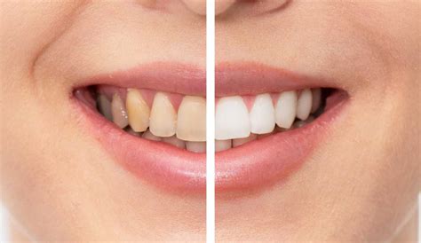 Cibi che macchiano i denti: se pensi al caffè stai sbagliando | Cosa ...