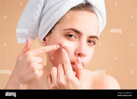 Close up beautiful girl squeezing pimples on her face. Acne blemish spots skin on young woman ...