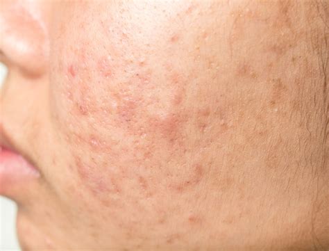 Premium Photo | Scar from acne on face