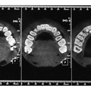 Mucoperiosteal flap reflection and bone removal. | Download Scientific ...