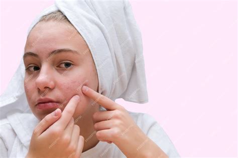 Premium Photo | Acne teenage girl squeezing out pimples on her face