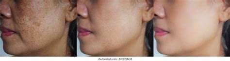 1+ Thousand Before After Skin Whitening Royalty-Free Images, Stock Photos & Pictures | Shutterstock