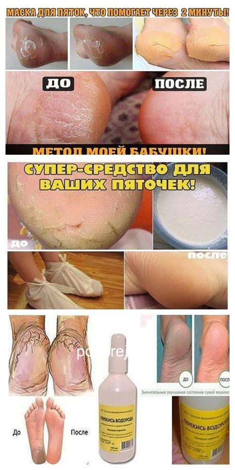 ВОЛШЕБНОЕ СРЕДСТВО ДЛЯ ВАШИХ ПЯТОЧЕК. ЭФФЕКТ ПОТРЯСАЮЩИЙ!