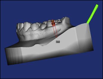 Anatomic assessment of the mandibular buccal shelf for miniscrew ...