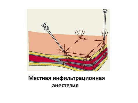 Местное обезболивание - online presentation
