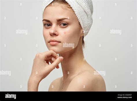 pretty woman with a pimple on the face dermatology isolated background Stock Photo - Alamy