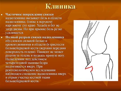 Разрыв связок коленного сустава: симптомы и лечение