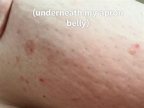 weird rash appearing over body? : r/DermatologyQuestions