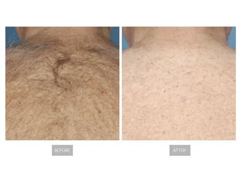 What to Expect: IPL Hair Removal Before and After Results - konmison ...
