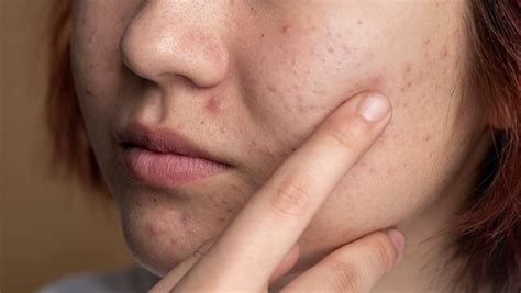 Почему появляются прыщи? - Natural-cosmetology.ru