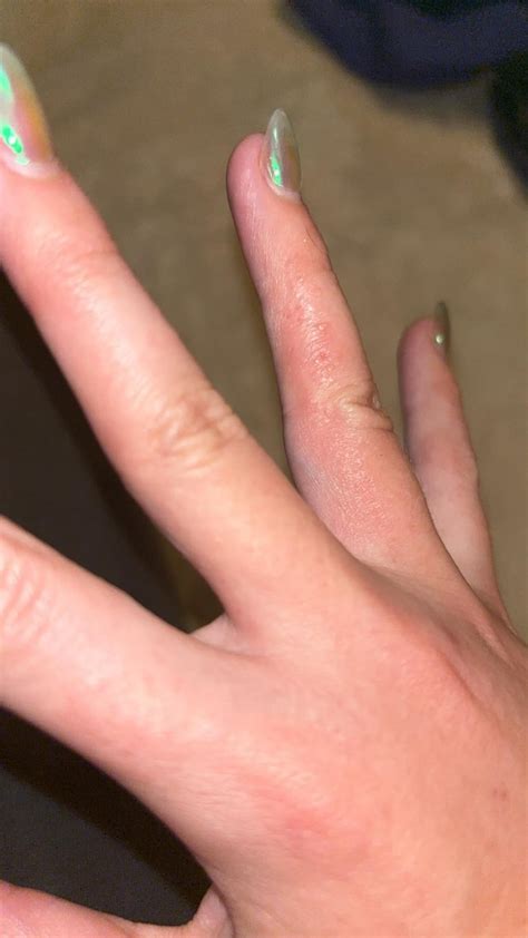 Photos attached got told from an urgent clinic I have either dermatitis or eczema supposed to go ...