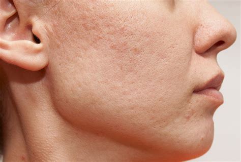 What Causes Blemishes and How to Get Rid of Them