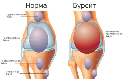 Бурсит, или воспаление синовиальной сумки сустава: симптомы и методы ...