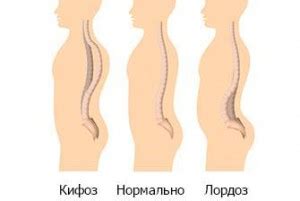 Что такое гиперлордоз поясничного и шейного отделов позвоночника?