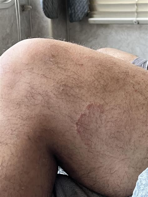 Weird rash : r/DermatologyQuestions