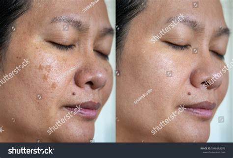 Face pigmentation before after Images, Stock Photos & Vectors | Shutterstock