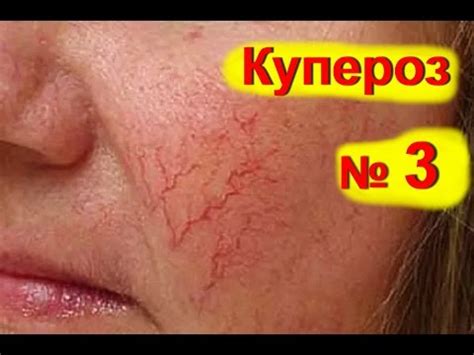 Купероз на лице ! Средства от купероза - розацеа лечение -№ 3 - YouTube