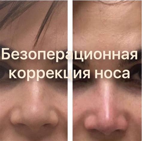 Липолитики для лица: отзывы, фото до и после применения