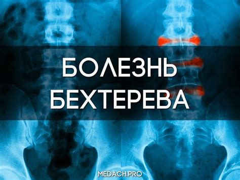 Болезнь Бехтерева
