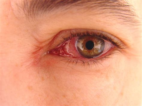 Eyes Change Color When Sick at Carissa Richards blog