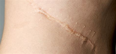 Scars | Dermatology and Skin Health - Dr. Mendese