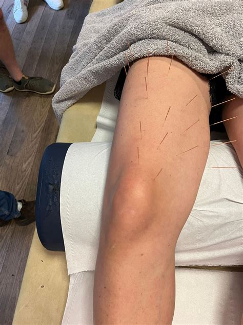 Master Tung Acupuncture - Advanced Course - International College of ...