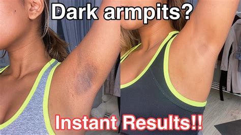 How To Get Rid Of Dark Armpits INSTANTLY! 100% works in 2024 | Dark armpits, Dark underarms ...