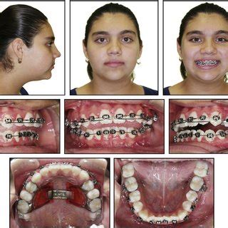 Pretreatment facial and intraoral photographs. | Download Scientific ...