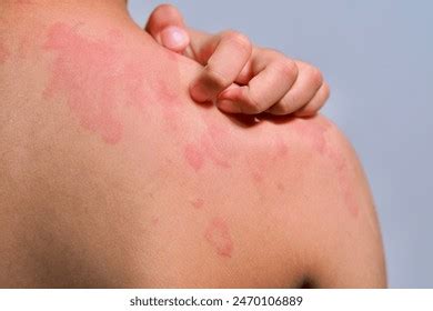 2 978 Urticaria Scratch Images, Stock Photos, 3D objects, & Vectors | Shutterstock