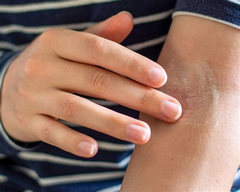 Atopik Dermatit – Alerji ile Yaşam Derneği