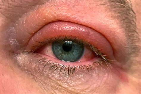 My Eyelid Is Swollen - Infoupdate.org