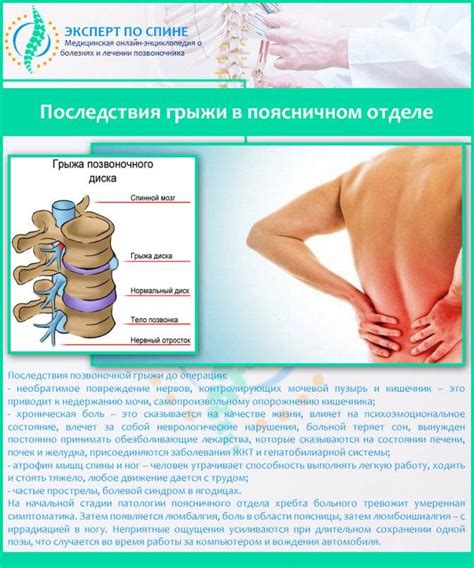 Упражнения при грыже позвоночника по бубновскому на тренажере