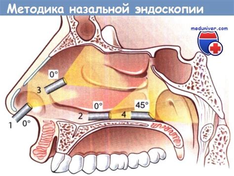 Что видит ЛОР при эндоскопическом осмотре носа?