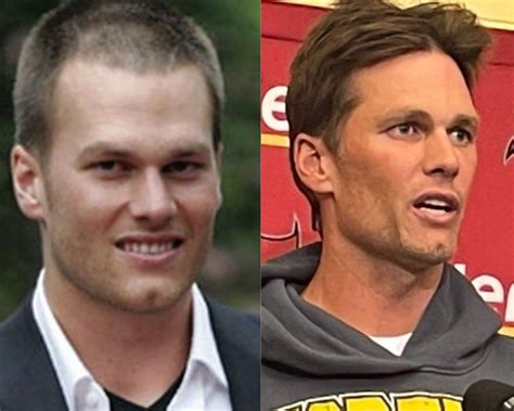 Unveiling the Truth Behind Tom Brady’s Plastic Surgery Procedures