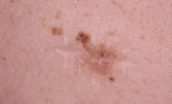 Что бывает после удаления родинки | Статьи, блог клиники BeautyWay Clinic