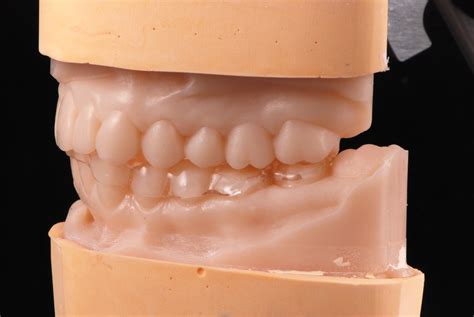 Сплинт каппа Cad/Cam | зуботехническая лаборатория Dentservice