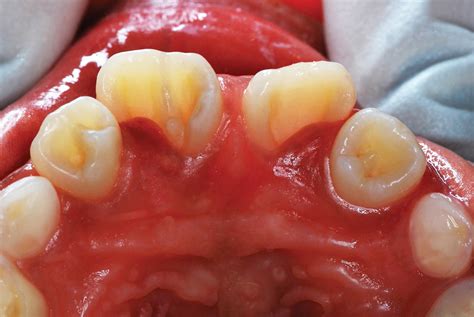 Dens In Dente Lateral Incisor