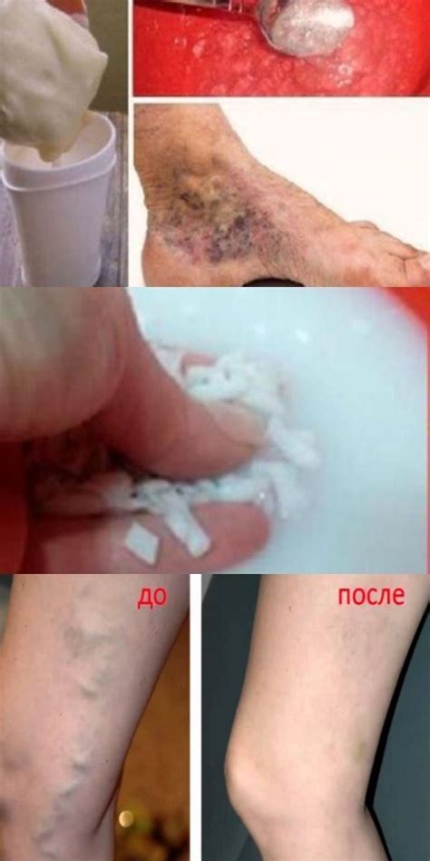 Полезные советы Попробуй это волшебное средство при варикозе и тромбозе ...