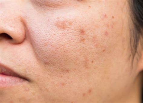 Manchas en el rostro: ¿cómo tratarlas? - Revista Vive