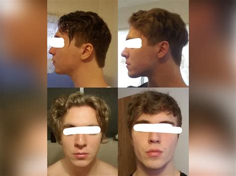 Mewing Before & After Results: 70+ Crazy Transformations