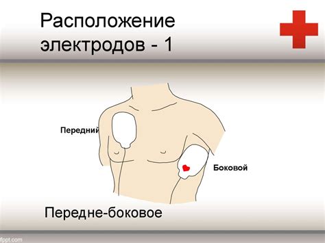 Дефибрилляция сердца - презентация онлайн