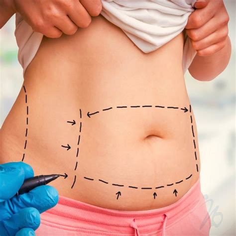 Procedimientos Corporales - ABDOMINOPLASTIA CIRCUNFERENCIAL - dr-normanblanco.com