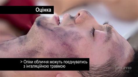 Опіки в ТССС (18+) - YouTube