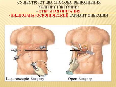 Желчно-каменная болезнь. Острый холецистит - презентация онлайн