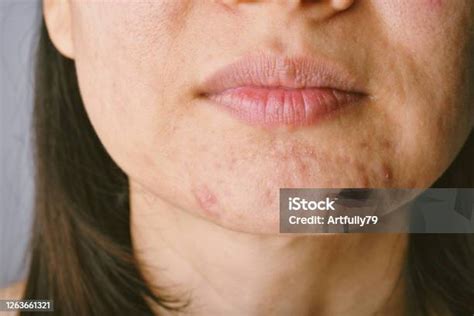 Skin Problem With Acne Diseases Close Up Woman Face With Whitehead Pimples On Chin Menstruation ...