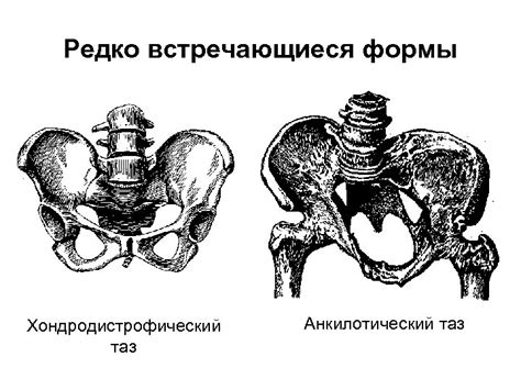 Узкий таз Классификация — Анатомически узкий таз