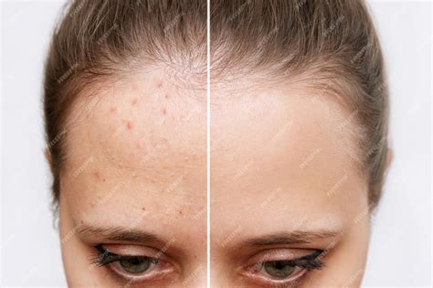Premium Photo | Cropped shot of young woman face before after acne treatment on face pimples red ...