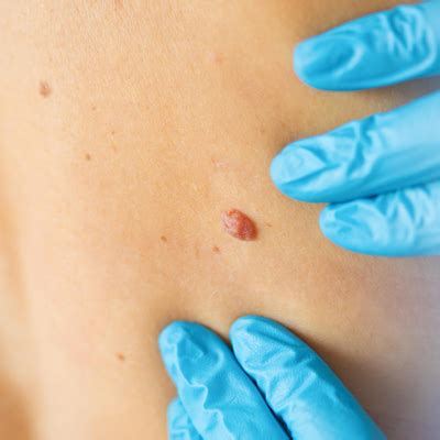 Skin Tags Removal: Dermatologist-Approved Techniques – Dermatology North Sydney
