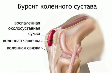 Бурсит, синовит — МЦ "Максимед"