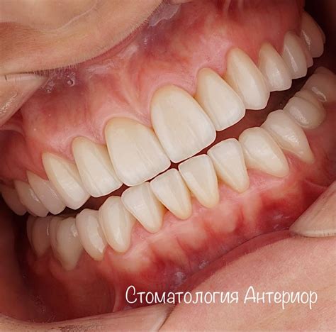 Естественное протезирование